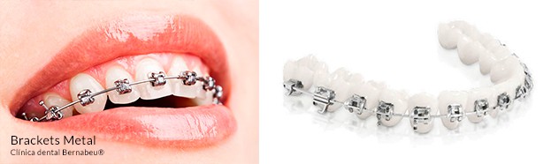 Brackets metálicos o estéticos - ortodoncia de metal - Clínica Bernabéu